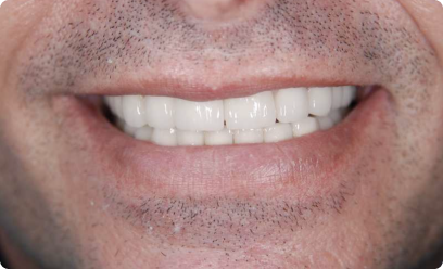 Dental Fixed Bridges - Demajo Dental